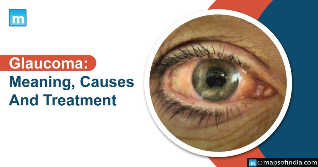 Glaucoma: Meaning, Causes And Treatment - Eyes
