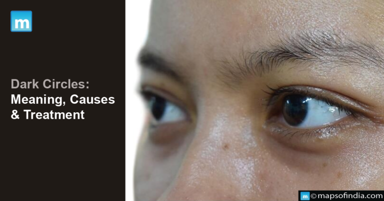 Dark Circles: Meaning, Causes And Treatment - Lifestyle