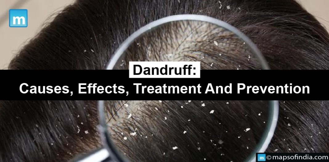 Dandruff: Causes, Effects, Treatments And Preventions - Care