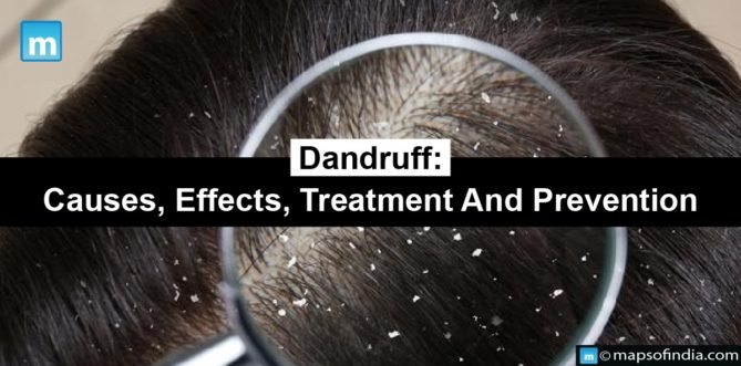 Dandruff: Causes, Effects, Treatments And Preventions - Care